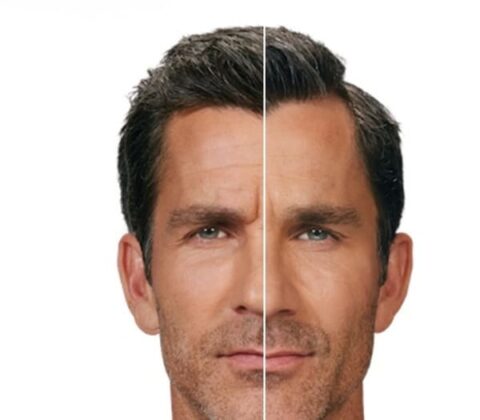 Botox Cosmetic Treatments in Napa Valley and Vacaville