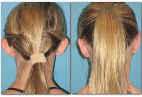 Otoplasty Ear Procedure | Napa Valley and Vacaville