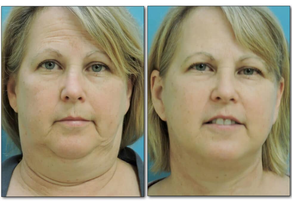 Neck Liposuction | Napa Solano Plastic Surgery & MedSpa
