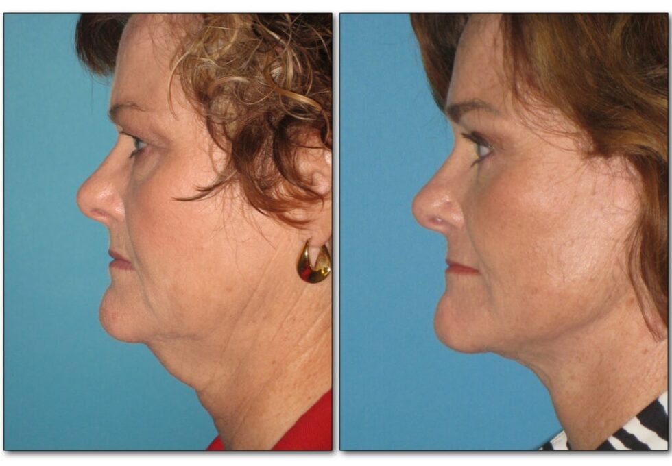 Facial Procedures for Radiant Skin | Napa Valley & Vacaville