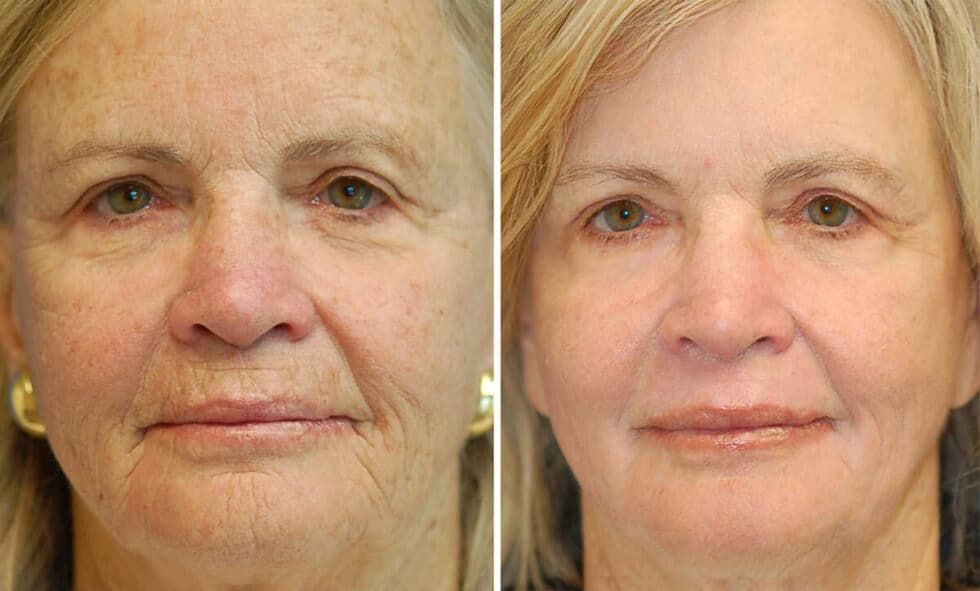 Sciton® Erbium Laser Skin Resurfacing Napa Solano Plastic Surgery